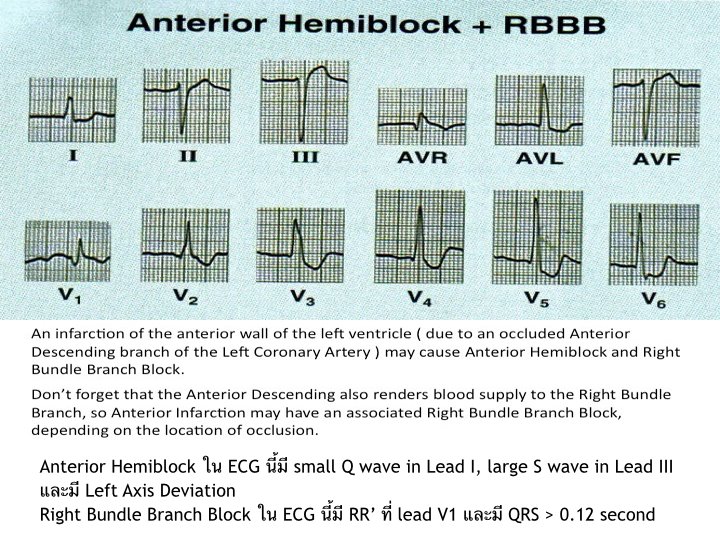 complete block และ incomplete block