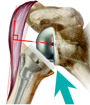 UW Shoulder and Elbow Academy: Scapular notching, it's not about the ...