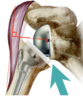 Shoulder Arthritis/Joint Replacement Rotator cuff tears: The dislocated ...