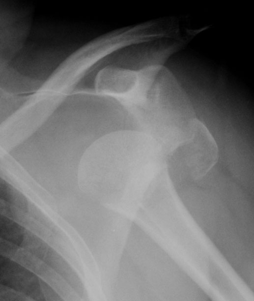Shoulder Arthritis / Joint Replacement : Shoulder fracture dislocation ...