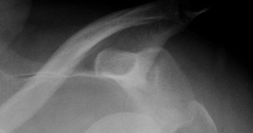 Shoulder Arthritis / Rotator Cuff Tears: causes of shoulder pain ...