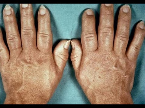 Filmarte MX: Acromegalia