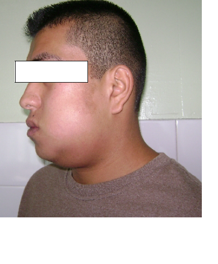 Ambar: Abscesos maxilares