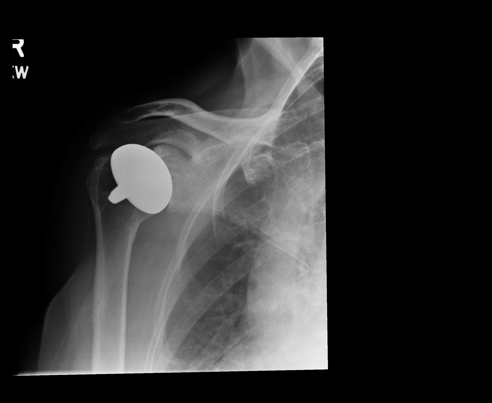 Daily Dose: Copeland shoulder replacement