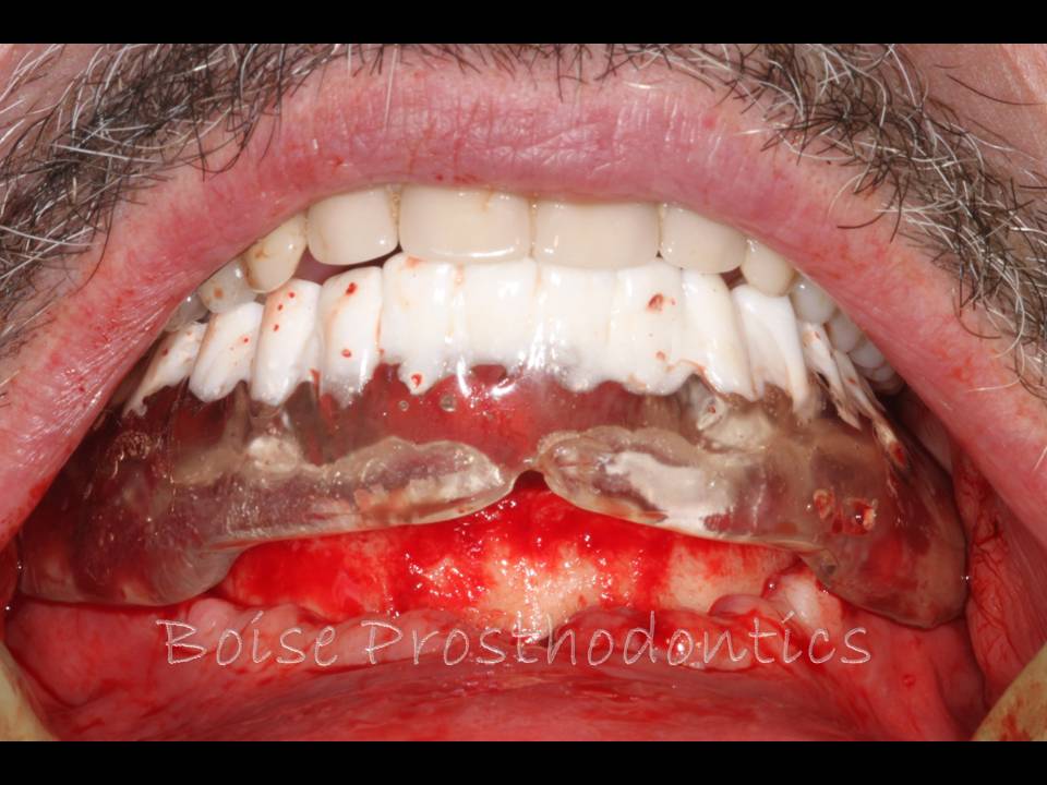 Boise Idaho Prosthodontics: Picture Sequence of Maxillary Complete ...