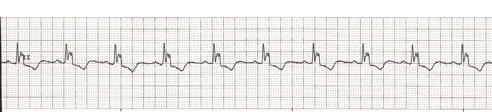 EKG Rhythm Strips 71