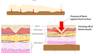 Staging Of Decubitus Ulcers - Ulcer Choices