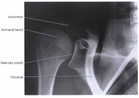 POSTERIOR OBLIQUE POSITION - GLENOID CAVITY: SHOULDER (NONTRAUMA ...
