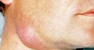 Abscesses and cellulitis of the head and neck