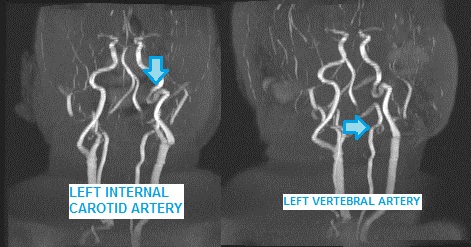 POINT OF VIEW: DX: Left Carotid Artery Loop or Coil. Vertebral artery ...