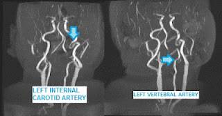 POINT OF VIEW: DX: Left Carotid Artery Loop or Coil. Vertebral artery ...