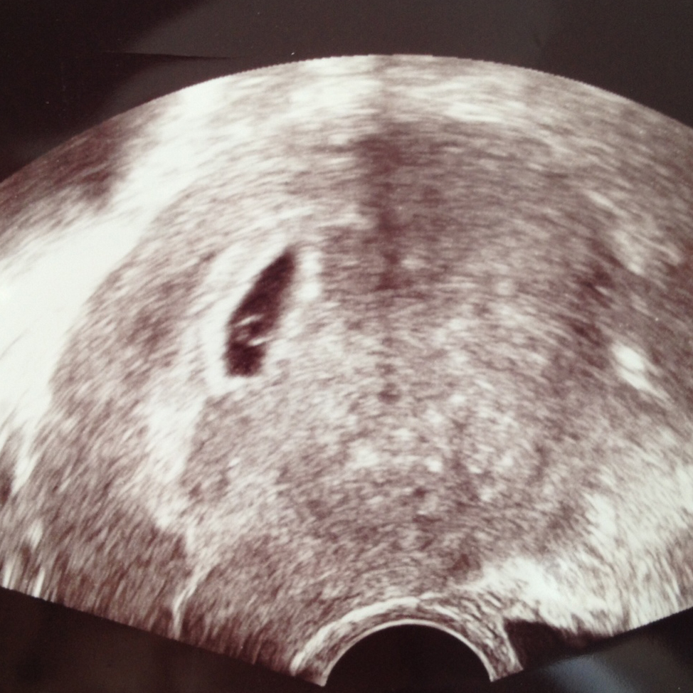 SCHWANGERSCHAFT & BABY: SSW 6 - Frauenartztermin