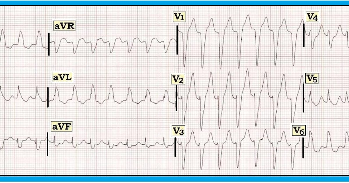 ECG Interpretation: ECG Interpretation Review #41 (WCT - Wide Complex ...
