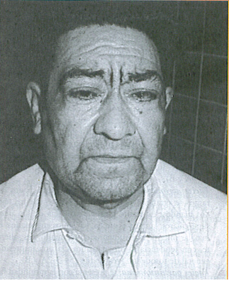 Apuntes Sobre Semiología Quirúrgica: Facies