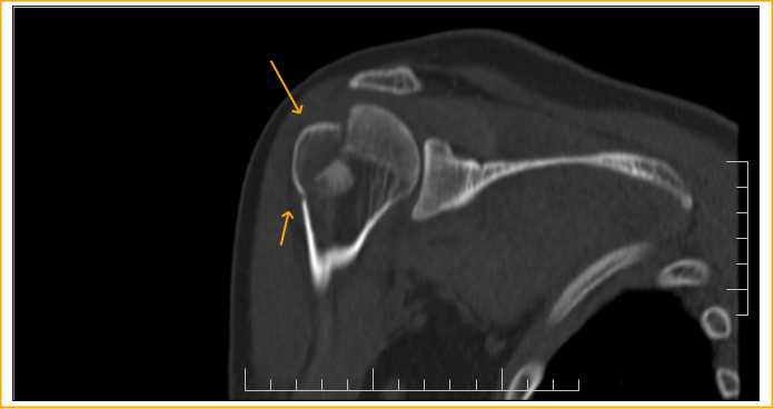 Symmetrical Post Dislocation Greater Tuberosity Fractures-CT - Sumer's ...
