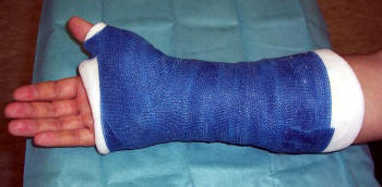 Fractura de escafoides | Medicusmeo