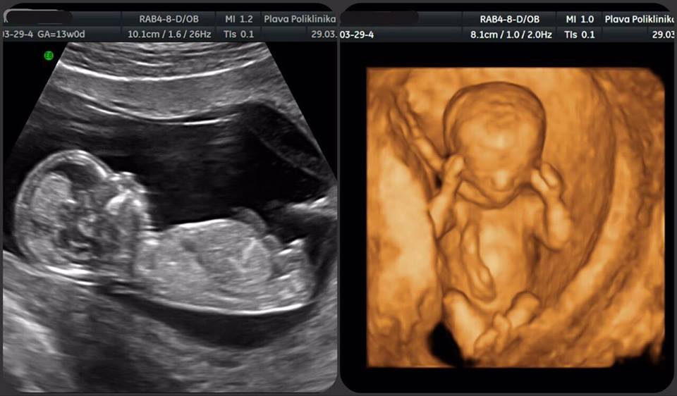 Mr.sci.dr.Dženita Kurtćehajić: Važnost ultrazvučnih pregleda u I i II ...