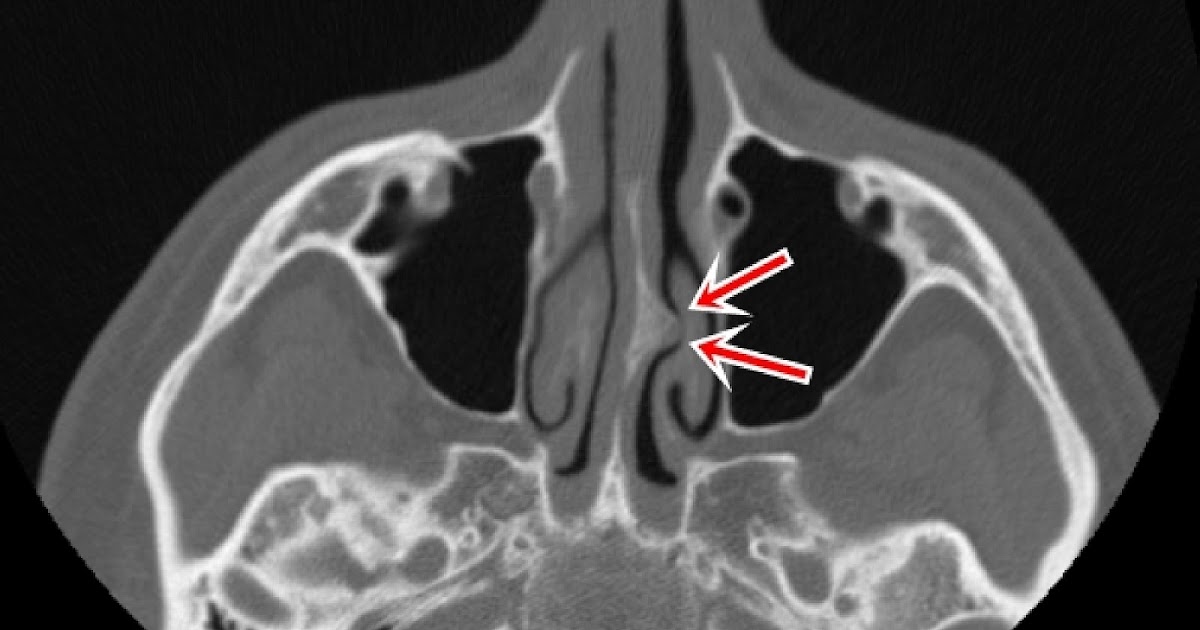 Ossified Overhang (Osteophyte) In The Nose That Can Cause Atypical ...
