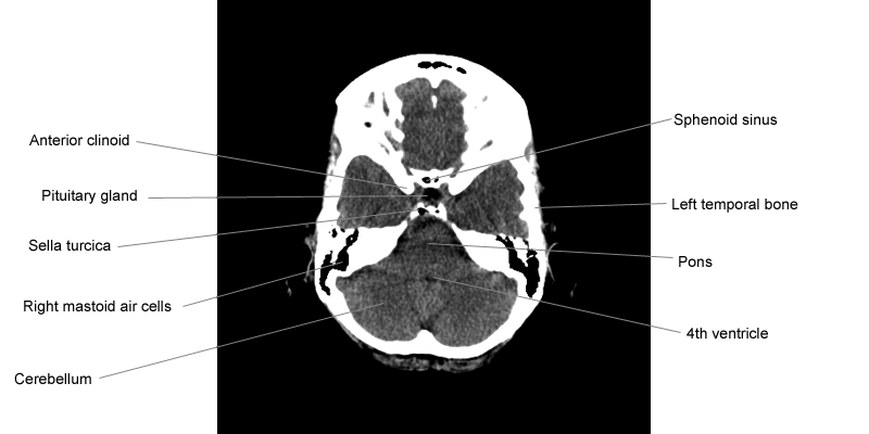 sinaune perawat: Gambaran Normal CT (Computed Tomography) Scaning ...