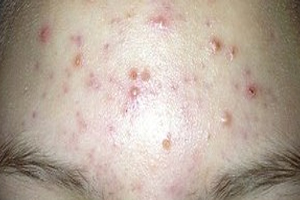 5 WORST ACNE MOST FEARED IN THE WORLD - HEALTH MAGAZINE