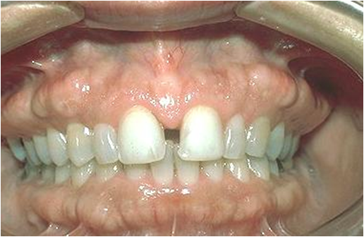 Healthy Ranula: Notes on Developmental defects of the oral and ...
