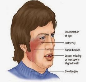 Fractures of the Skull, Face, Jaw, Upper Body, Arm and Hand, and ...