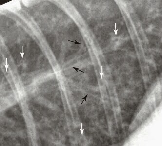 Chest Medicine Made Easy-Dr Deepu: The Rings !!!The Trams!!!, Chest X ...