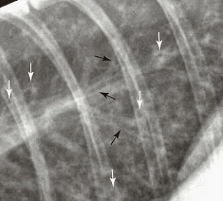Chest Medicine Made Easy-Dr Deepu: The Rings !!!The Trams!!!, Chest X ...