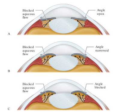 [Emergency] ATLAS OF ACUTE ANGLE-CLOSURE GLAUCOMA | Free Medical Atlas
