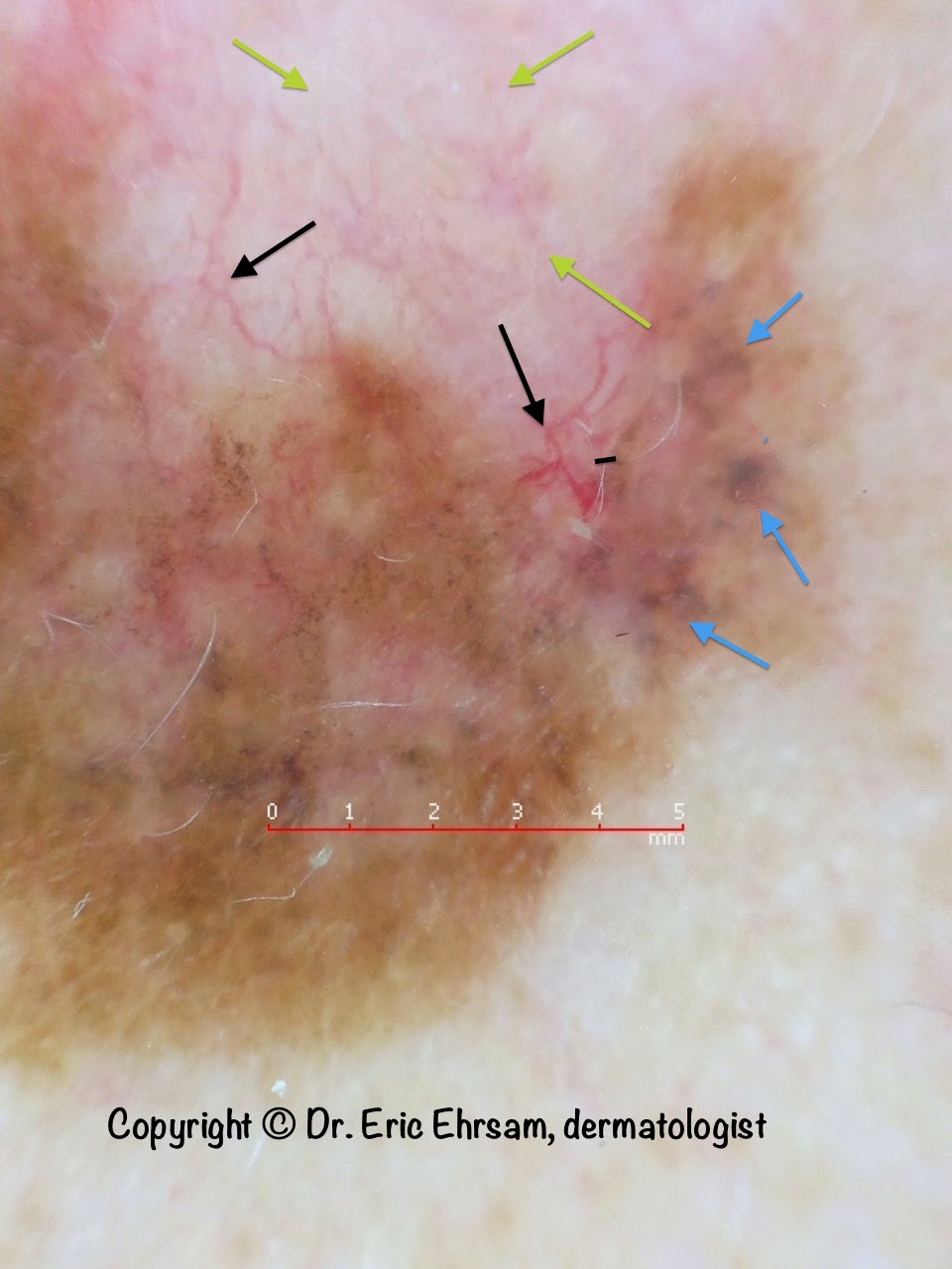 dermoscopy: June 2014