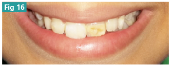 Molar Incisor Hypomineralization (MIH): Conservative Treatment Approach