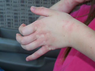 Beyond the Mirror: What Cold Induced Urticaria Looks Like