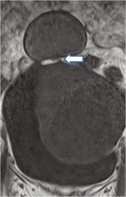 RADIODIAGNOSIS - IMAGE COLLECTION: PEDUNCULATED SUBSEROSAL FIBROID