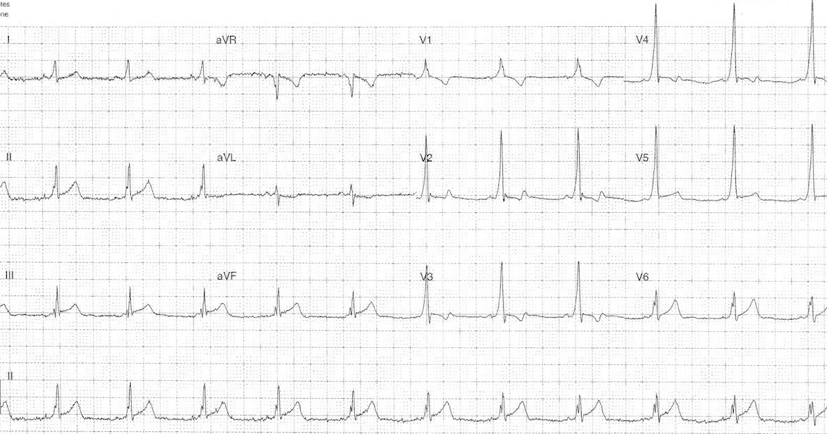 ECG of the Week: ECG of the Week - 13th March 2017 - Interpretation