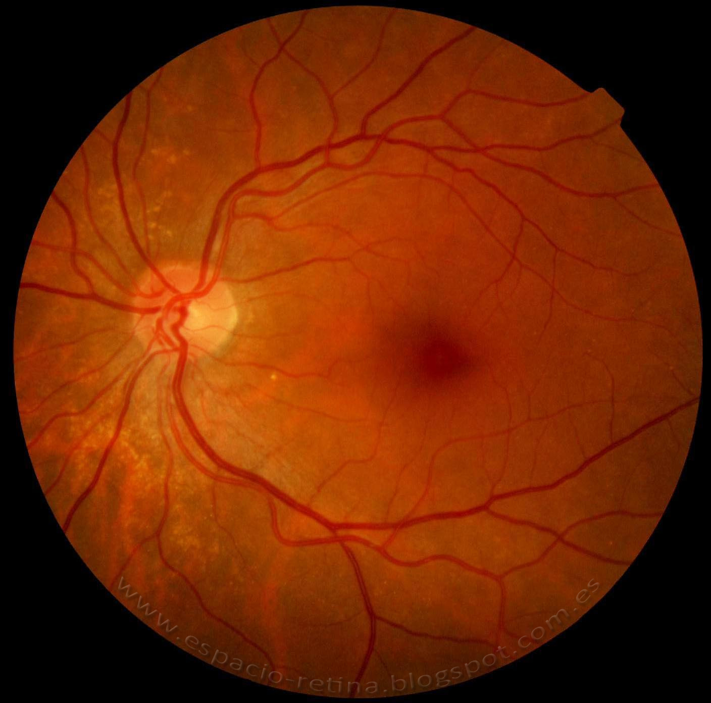 ESPACIO RETINA: Drusas.