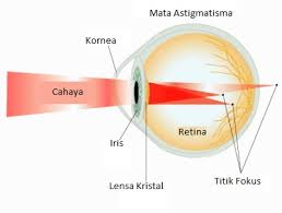 Mata Astigmatisma