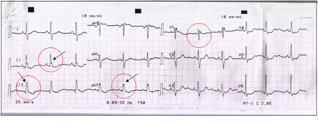 MEDI LEARNER: ATRIAL SEPTAL DEFECT (ASD)