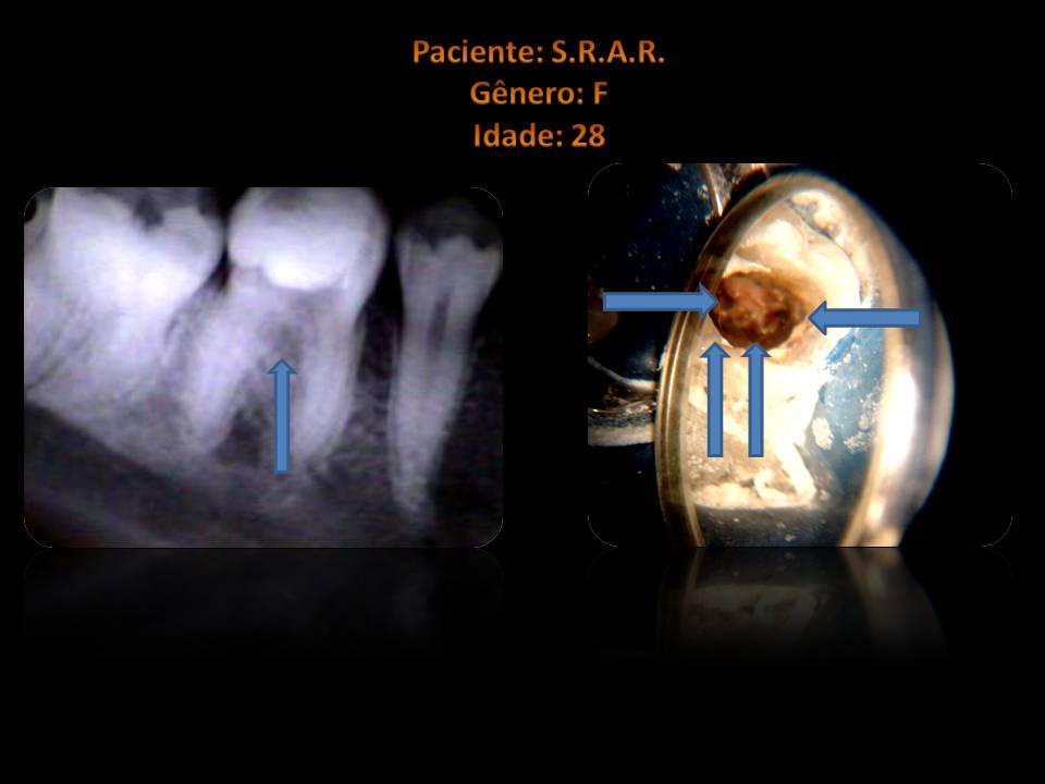 Endodontia Dr. Henrique Braitt: Molar atrésico, com perfurção