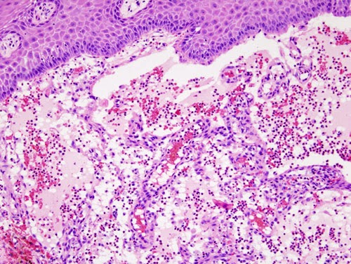 Estomatologia Online: Mucocele, Rânula e Sialolitíase