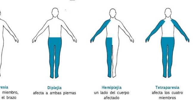 SOY FAN DE LA ACTIVIDAD FÍSICA: HEMIPARESIA CEREBRAL