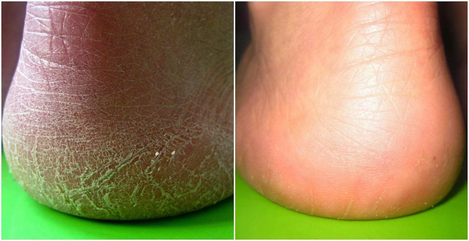 Elimina esos talones agrietados, la solucion: 10 remedios caseros ...