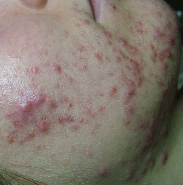 916SKIN - ACNE SKIN & WELLNESS CLINIC: March 2014