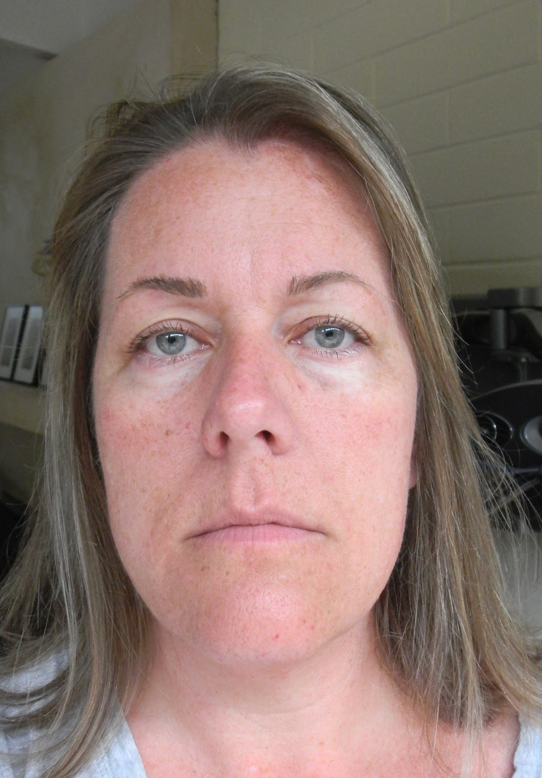 Efudex and Me 2013: 05/16/13