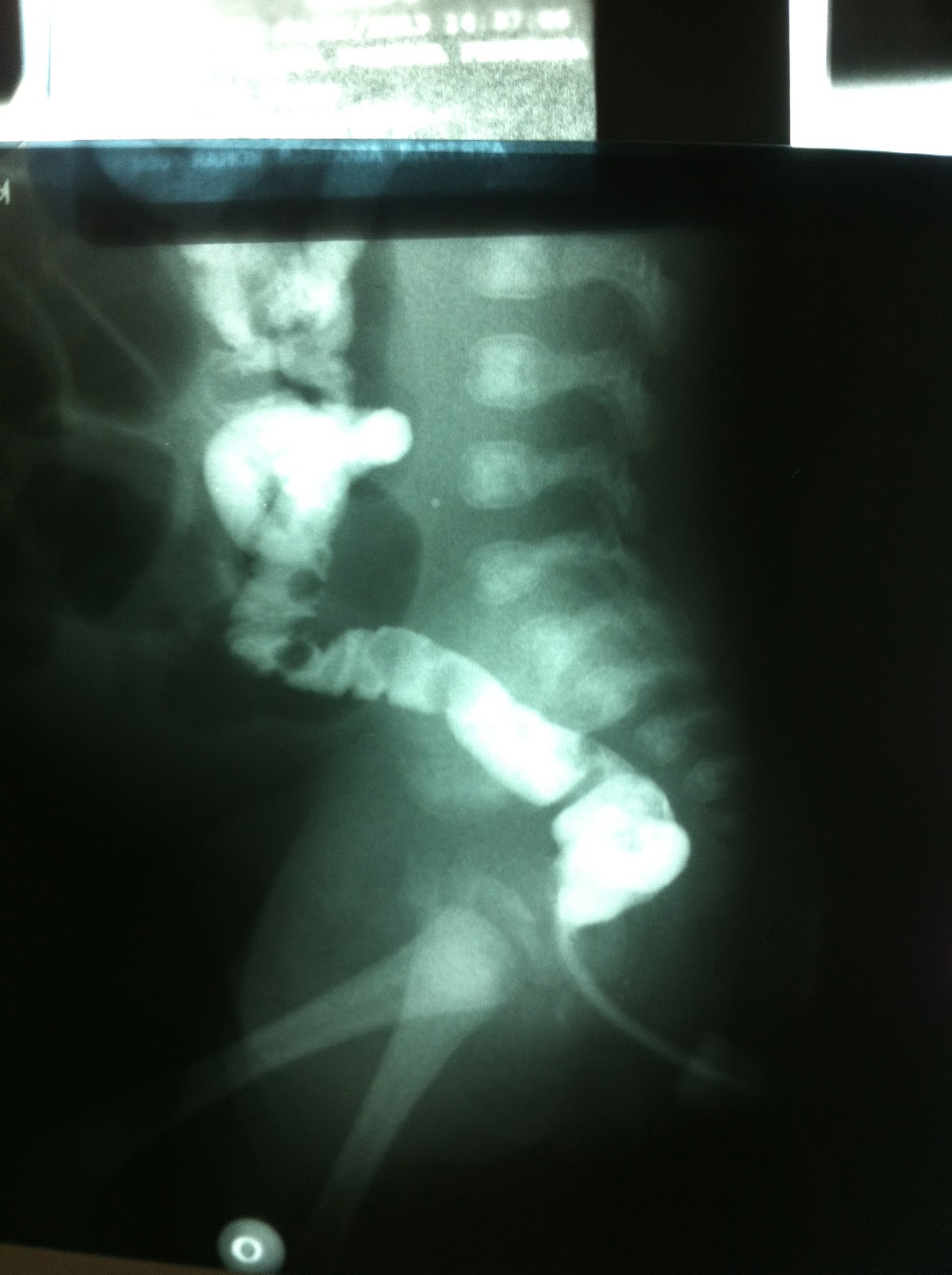 Radiologia Pediátrica: MICROCÓLON