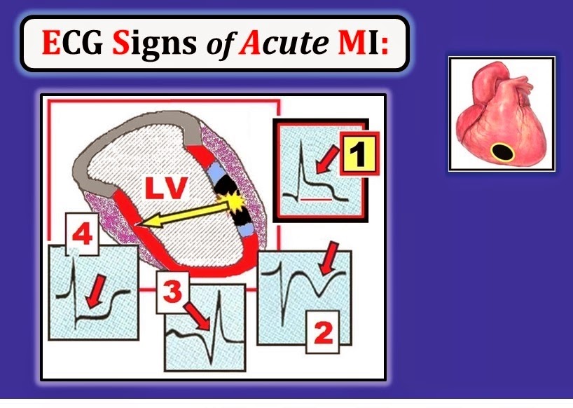 QRST changes : 네이버 블로그