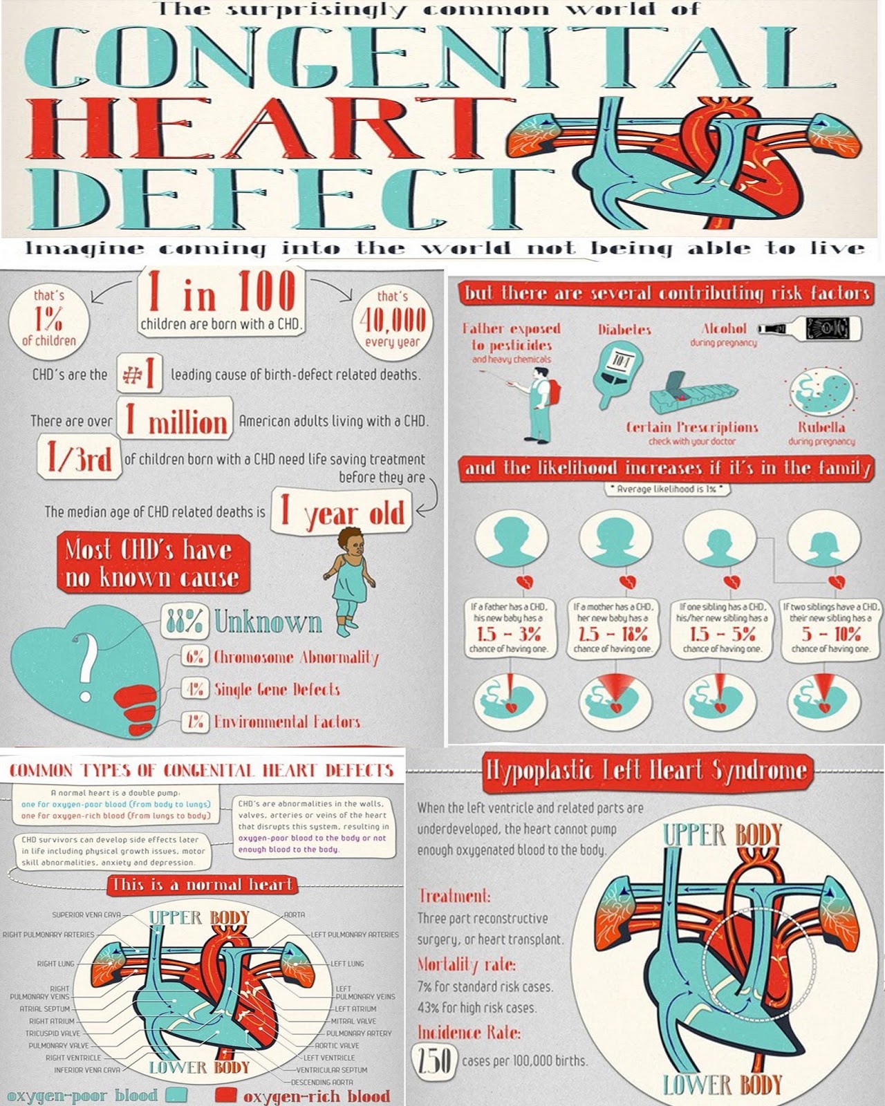 Paisley-Anns Special Heart: What in the world in Hypoplastic Left Heart ...