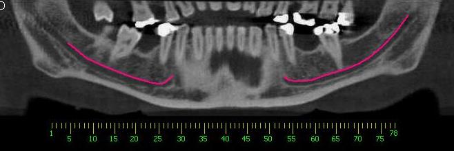 Técnicas radiológicas para la identificación anatómica del conducto ...