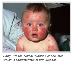 Just Bambinos Product Articles and Blogs: SLAPPED CHEEK DISEASE ...