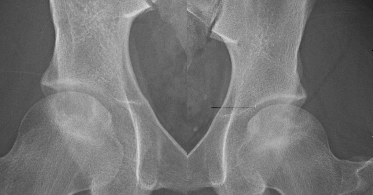 Roentgen Ray Reader: Ficat Classification of Avascular Necrosis (AVN ...