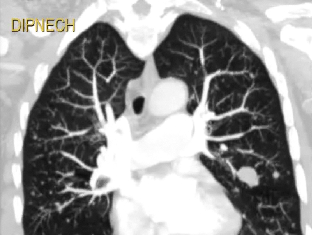 rsna: carcinoid and small cell lung cancer (별 10개)